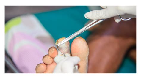 Diagnosing Pyoderma Gangrenosum Woundsource