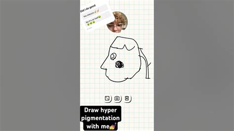 Drawing Hyperpigmentation Fypviralシ Youtube