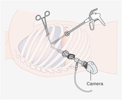Best Thoracoscopy Doctors In Delhi Thoracoscopy Hospital In Delhi NCR