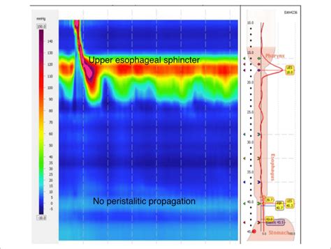 Nutcracker Esophagus High Resolution Manometry At Jennifer Wilkins Blog