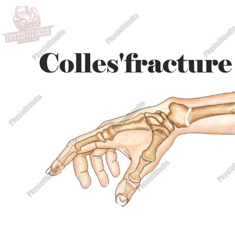 Collesfracture And Smiths Fracture Difference Between