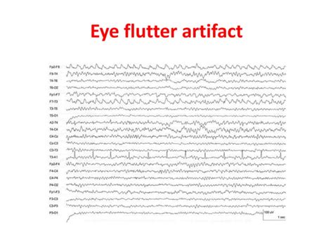 Eeg Artifacts