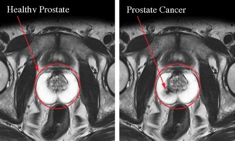 Figure 8 From Impact Of Intrafractional Prostate Motion On The Accuracy And Efficiency Of