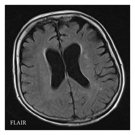 Patient 2 Noncontrast Brain Ct Scan A Showing A Diffuse Area Of Download Scientific Diagram