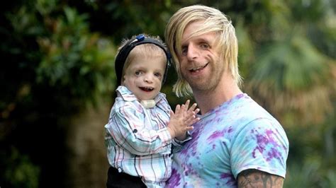 Treacher Collins Syndrome History Causes Symptoms Diagnosis And