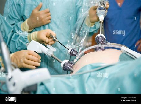 Laparoscopic Colon Cancer Surgery Surgeons Using Laparoscopic Tools To Remove A Carcinoma Of