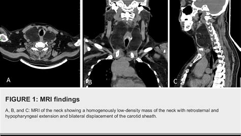 Figure 1 From Diffuse Thyroid Lipomatosis And Amyloid Goiter With Incidental Papillary Thyroid