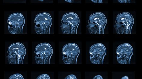 Cirugía Para Neuralgia Del Trigémino ¿cuándo Es Necesaria 🧠
