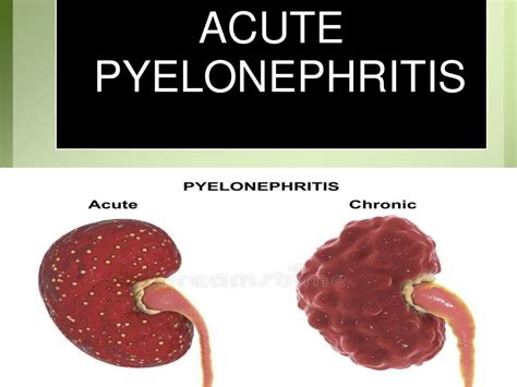 Pyelonephritis Acute Pyelonephritis Chronic Pyelonephritis