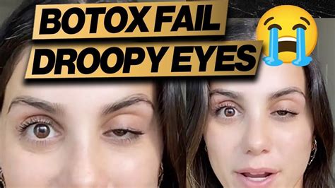 When Botox Gone Wrong Artofit When Botox Gone Wrong Artofit