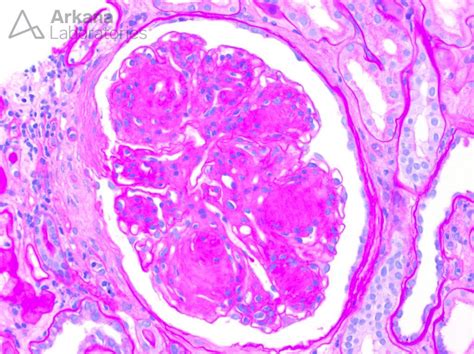 Diabetic Glomerulopathy Archives Arkana Laboratories