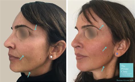 Best Non Surgical Facelift 2025 Non Invasive Face Tightening Procedures