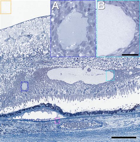 Intraretinal Exudative And Transudative Fluid In Donor Eyes With