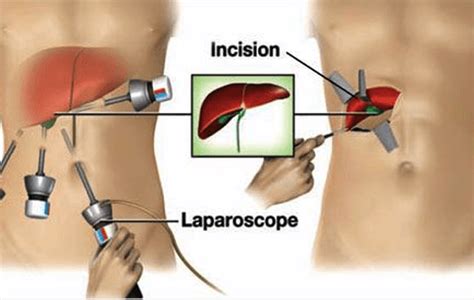 Liver Resection Laparoscopic And Open