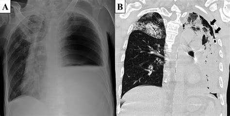 Tension Pyopneumothorax Pmc