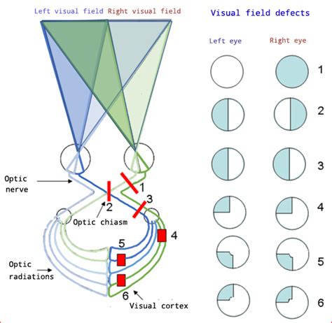 Visual Field Defects Causes And Treatment Doctor