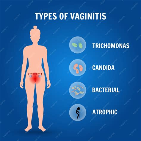 Premium Vector Medical Infographic Types Of Vaginitis In Vector