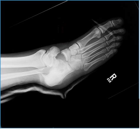 A Case Report Of Lateral Subtalar Dislocation Emergency Medicine