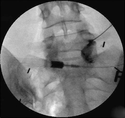 Transforaminal Epidural Steroid Injection Anesthesia Key