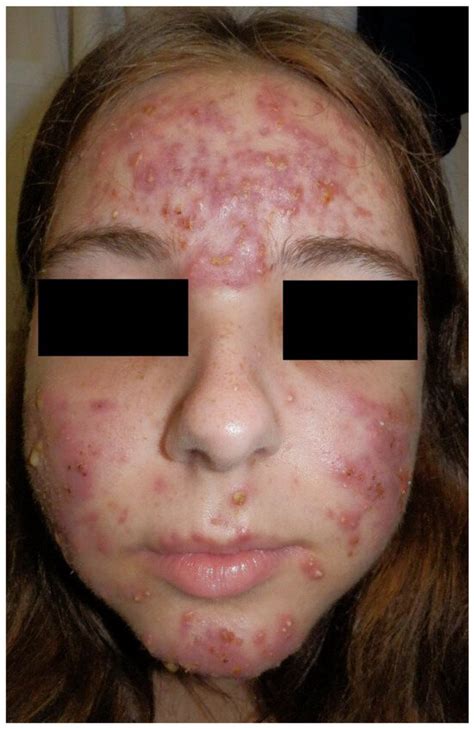 Diagnostic Challenges And Treatment Difficulties In A Patient With Excoriated Acne Conglobata