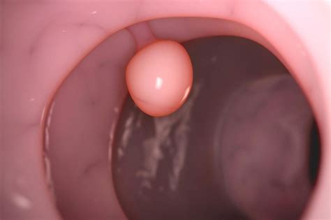 Cervical Polyp Doctency Com