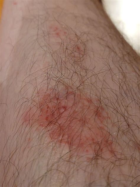 Itchy Rash On Shin Appeared A Few Months Ago Rdermatology
