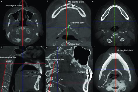 Axial Cone Beam Computed Tomography Cbct Images Depicting Download Scientific Diagram
