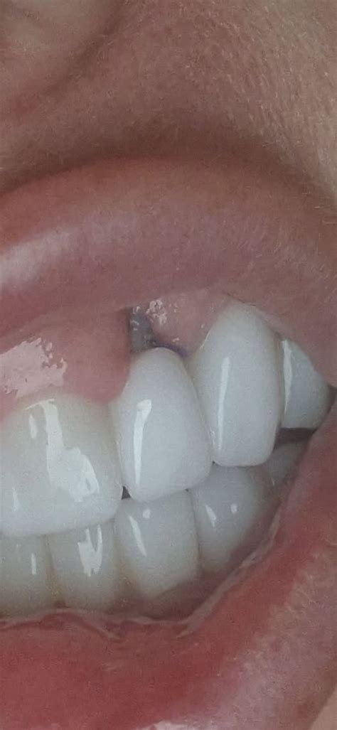 Gray Spot On Gums After Dental Veneers Or Crown Removal Heres What It