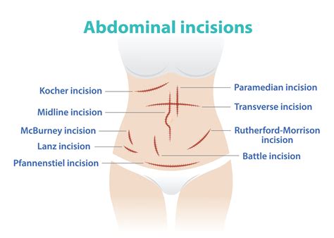 Tipos De Abdominal Incisión Para Cirugía Vector Ilustración Aislado En