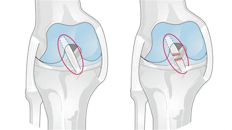 Acl Reconstruction Surgery Is A Second Hit To The Cartilage Time To Acl Reconstruction Surgery Is A Second Hit To The Cartilage Time To