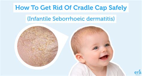 Cradle Cap Symptoms