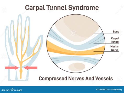 Carpal Tunnel Syndrome Compressed Median Nerve Carpal Tunnel Anatomy