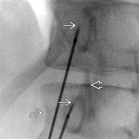 Medial Branch Block Thoracic Spine Clinical Tree
