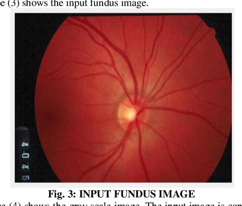 Figure 3 From An Efficient Design Of Blood Vessel Image Extraction