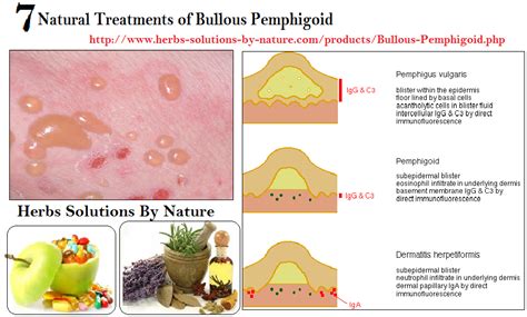 Bullous Impetigo Symptoms Causes Diagnosis Prevention Ayurvedic