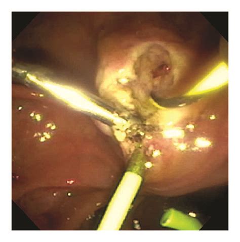 View Of The Ampulla Of Vater Following Needle Knife Fistulotomy Cbd Download Scientific