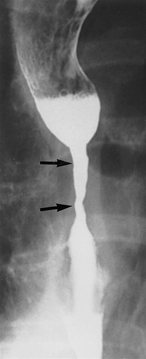 Endoscopy In Esophageal Stricture At Nathan Knutson Blog