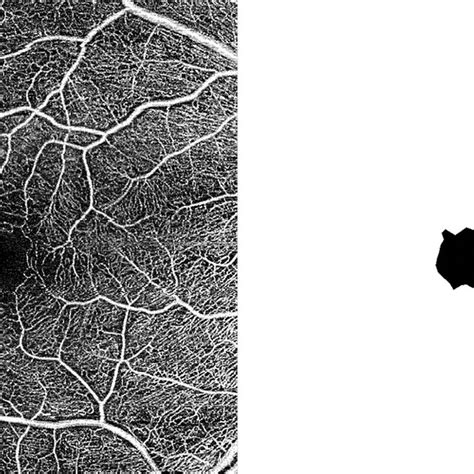 Octa Images 6 × 6 Mm Before Left And After Right The Faz Area Was Download Scientific