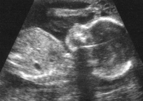 Grand Rapids Lab Develops Blood Test That Determines Fetus Sex Early In Pregnancy With