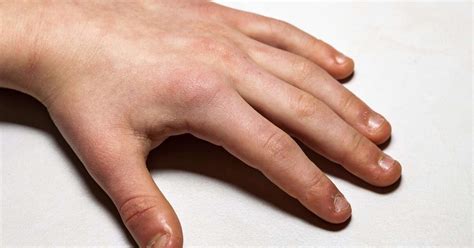 Ανωμαλίες των νυχιών Wikihealth Gr