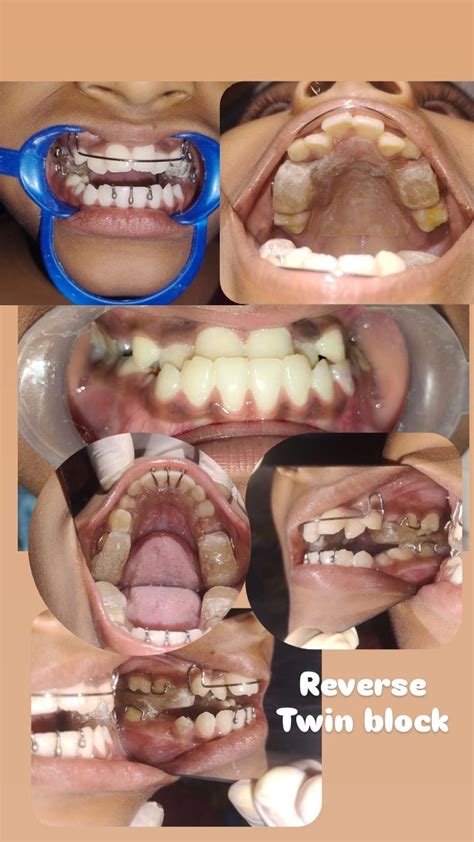 Skeletal Class 3 Correction By Reverse Twin Block Dr Soujanya Mandal