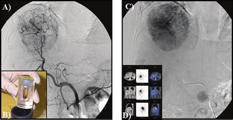 Y 90 Embolization For Hepatocellular Carcinoma A Selective Download Scientific Diagram