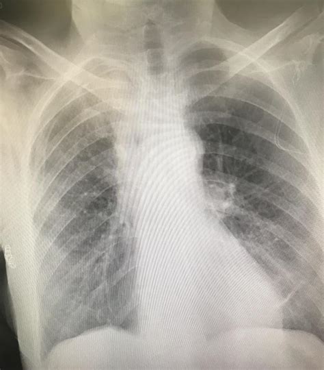 Really Nice Dissection For Rul S1 3 Anatomical Segmentectomy In A Lepidic… Carlos Galvez