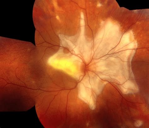 Pseudoxanthoma Elasticum March 2018 Illinois Retina Associates™ Top Retina Specialists In