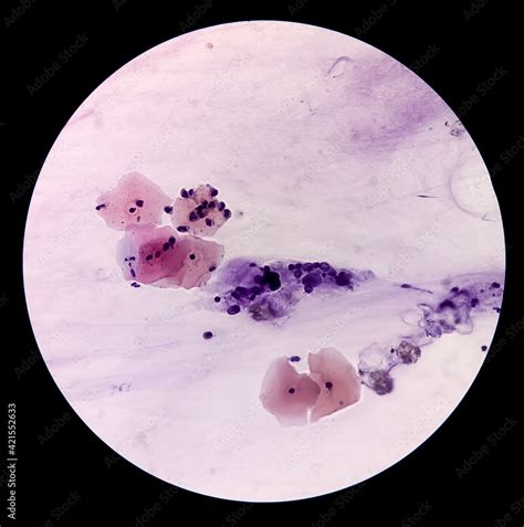 Microscopic View Of Histology Stained Slide Closeup Cell Carcinoma Biopsy Histology