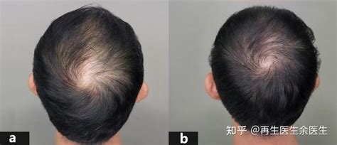 干细胞外泌体生发看看这3例脱发治疗的效果 知乎