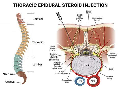 Steroid Injection Of The Spine At Bev Wood Blog