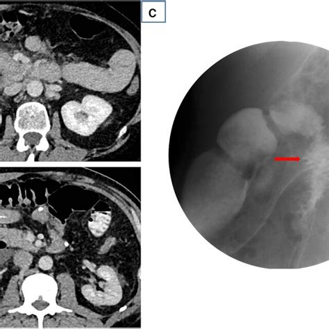 A B Computed Tomography Scans Of Cases 5 And 1 And C Download