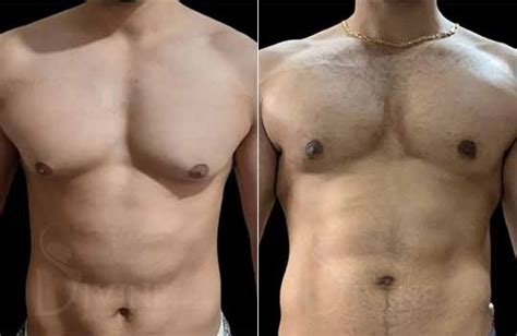 Puffy Nipples Or Gyno Know The Difference And Best Treatment