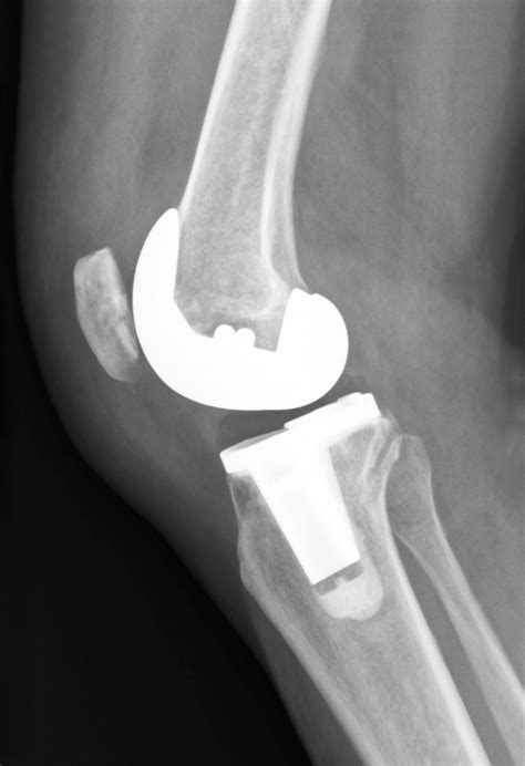 Knee Replacement Surgery Northeast Georgia Medical Center